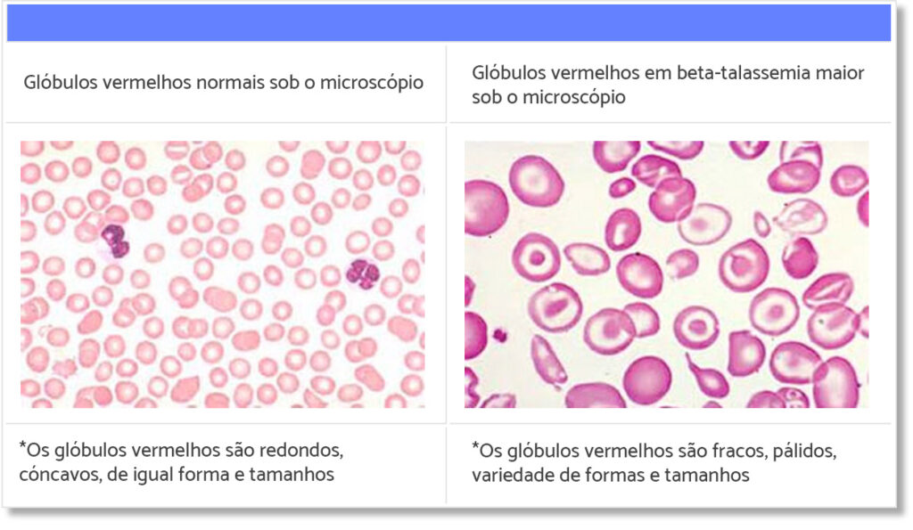 Os tipos de Talassemia - Abrasta